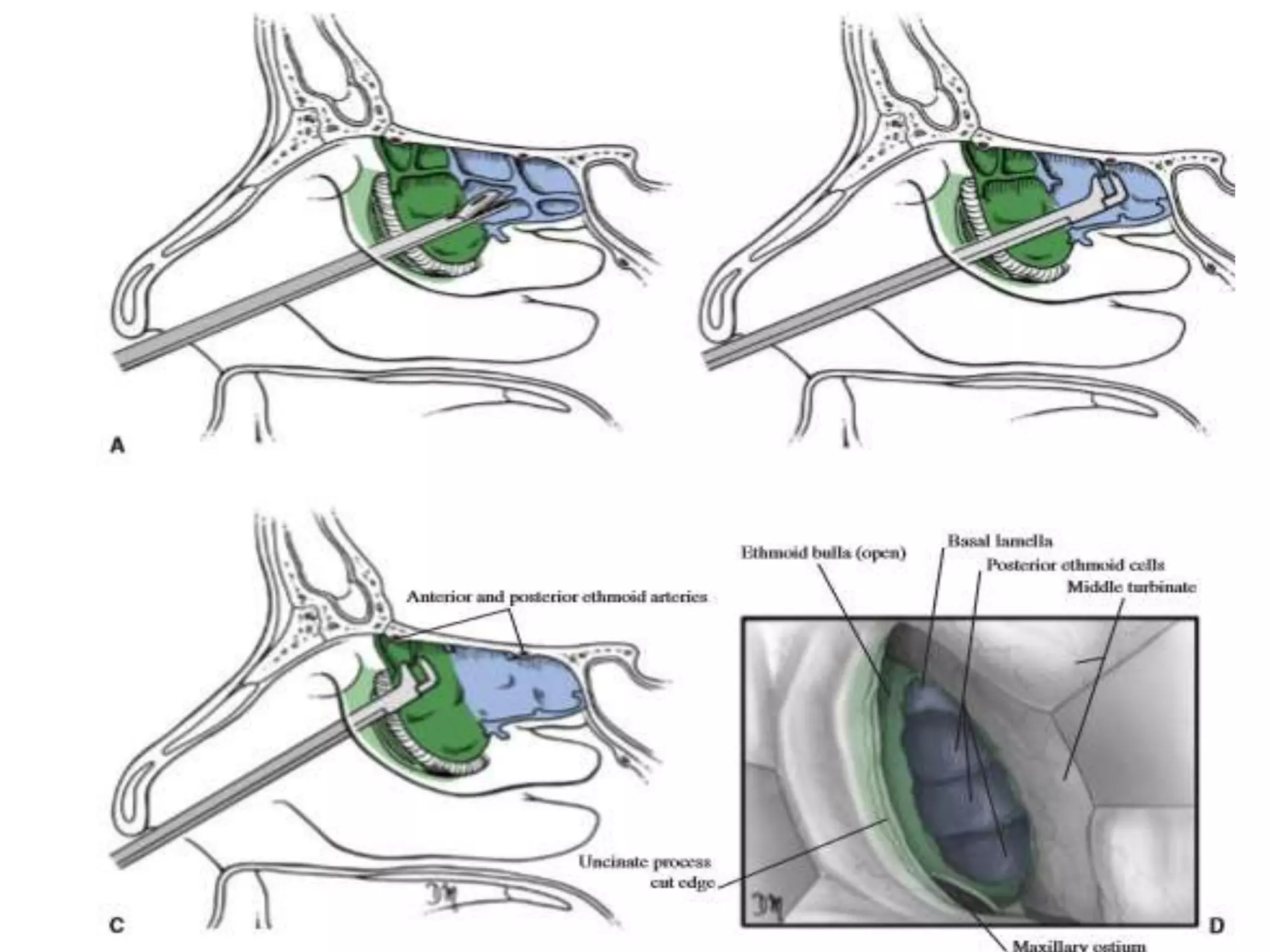 Functional endoscopic sinus surgery | PPTX | Ear, Nose and Throat ...