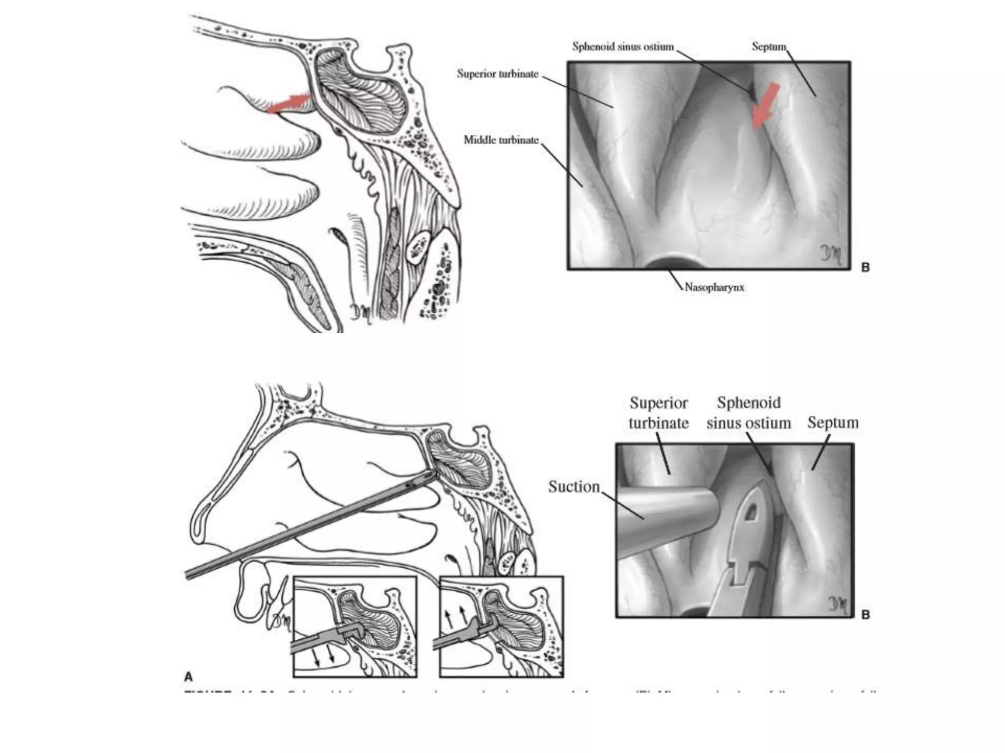Functional endoscopic sinus surgery | PPTX
