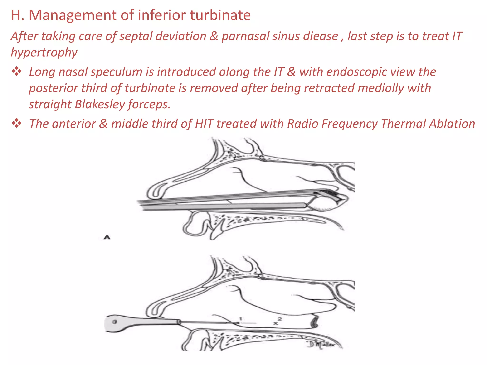 Functional endoscopic sinus surgery | PPTX