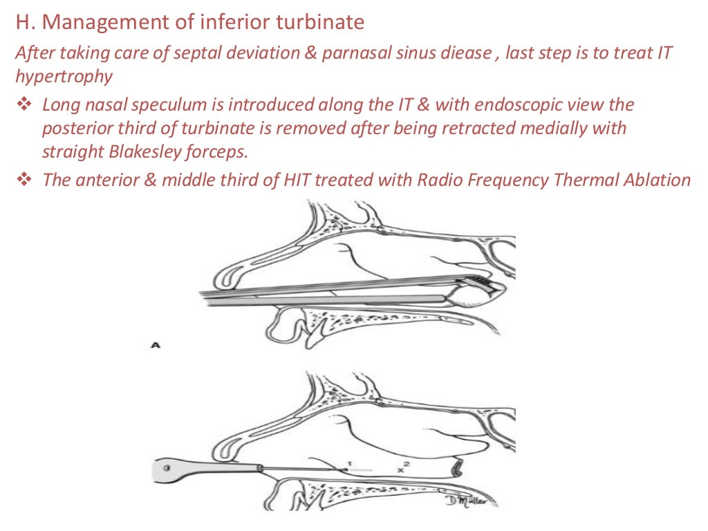 Functional endoscopic sinus surgery
