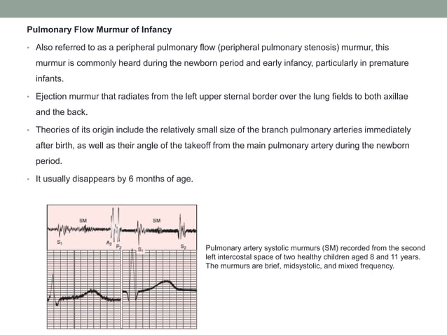 Functional flow murmur | PPTX