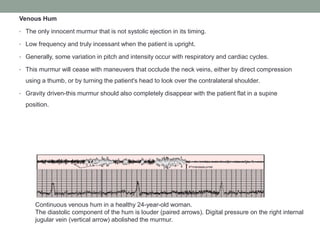 Functional flow murmur | PPTX