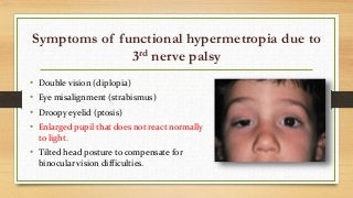 Functional hypermetropia group 3 | PPTX