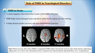 Role of Functional MRI in Neurological disorder | PPT