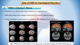 Role of Functional MRI in Neurological disorder | PDF