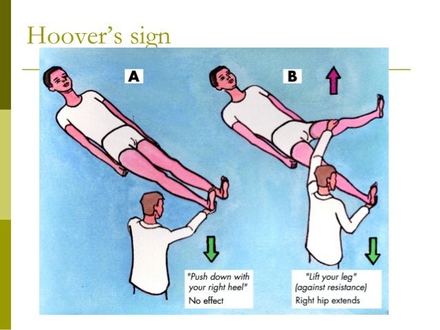 Hoover Zeichen Flexikon _ Mögliche Ursachen für Fassförmiger Thorax ...