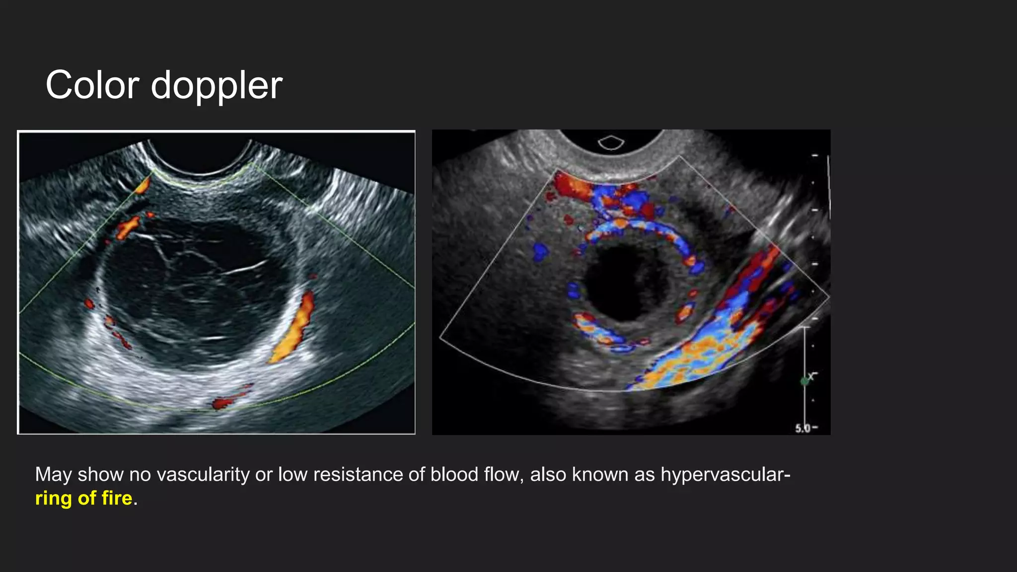 Functional ovarian cyst and its differential diagnosis | PPTX