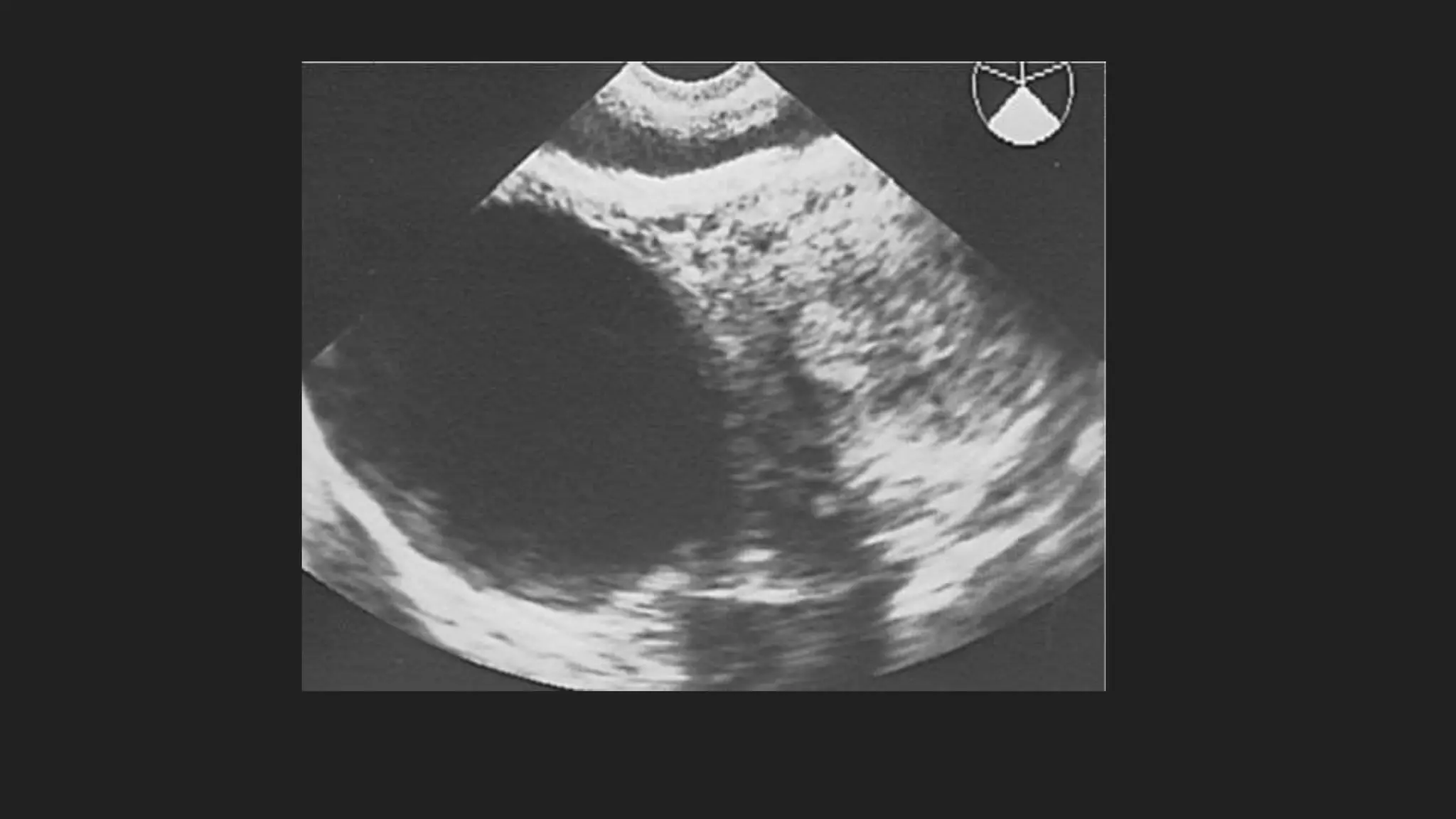 Functional ovarian cyst and its differential diagnosis | PPTX