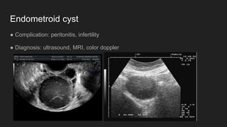 Functional Ovarian Cyst Ultrasound