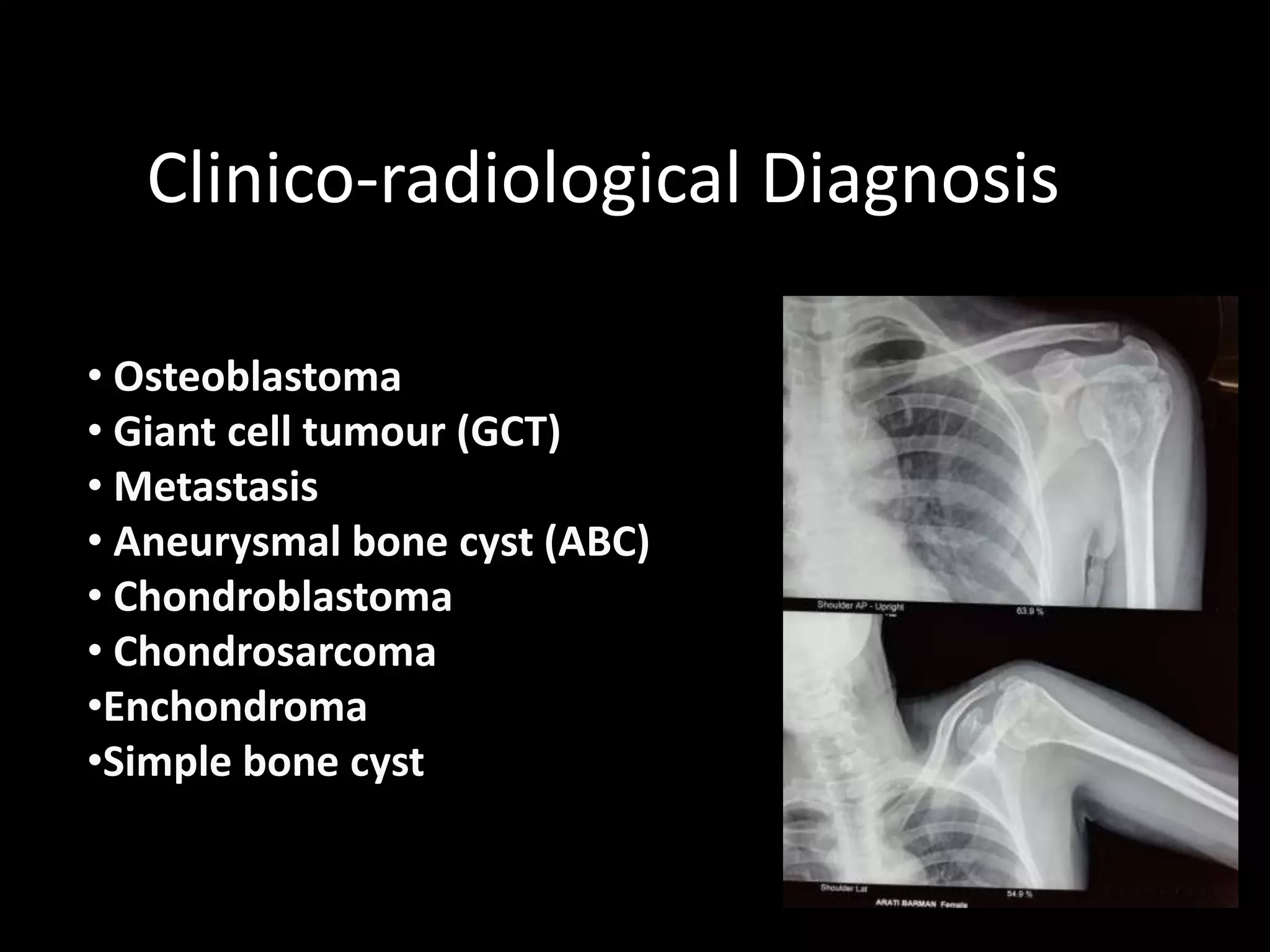 chondrosarcoma proximal humerus | PPTX