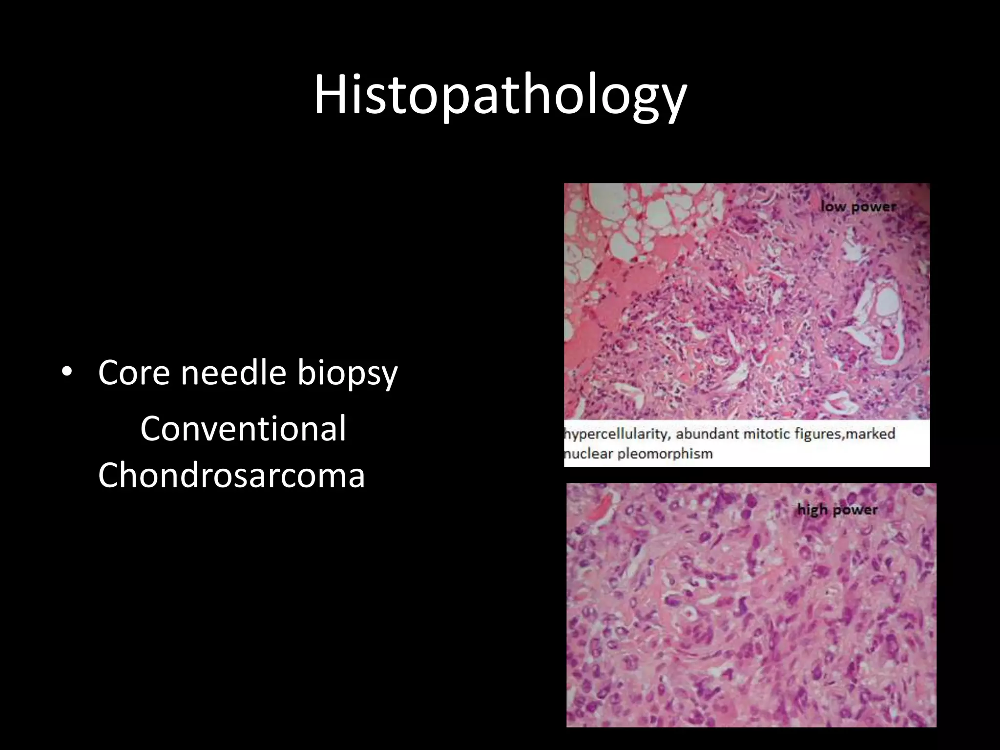 chondrosarcoma proximal humerus | PPTX