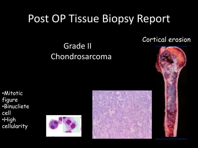 chondrosarcoma proximal humerus | PPTX | Bone and Joint Conditions ...