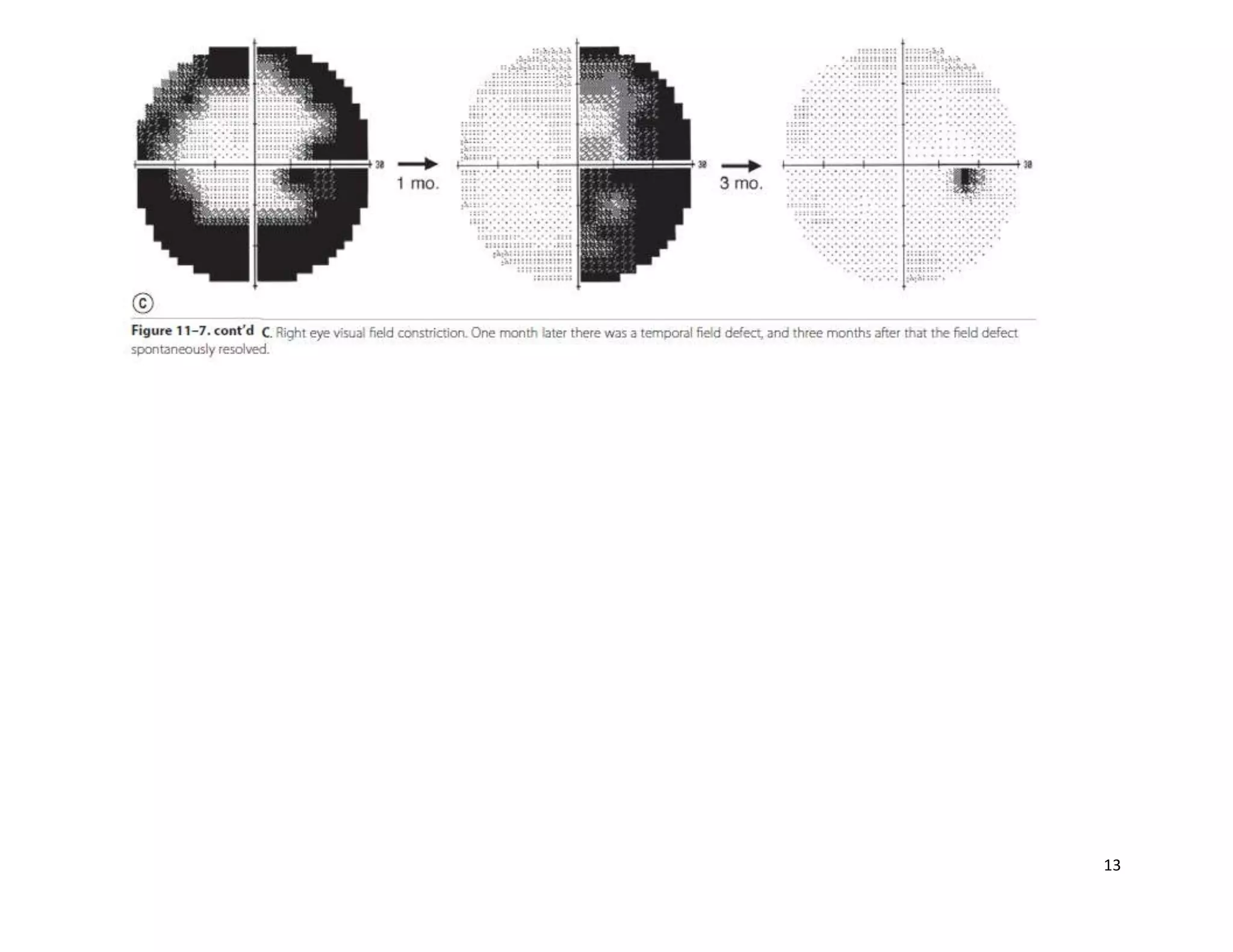 Functional vision loss table 2 | DOCX