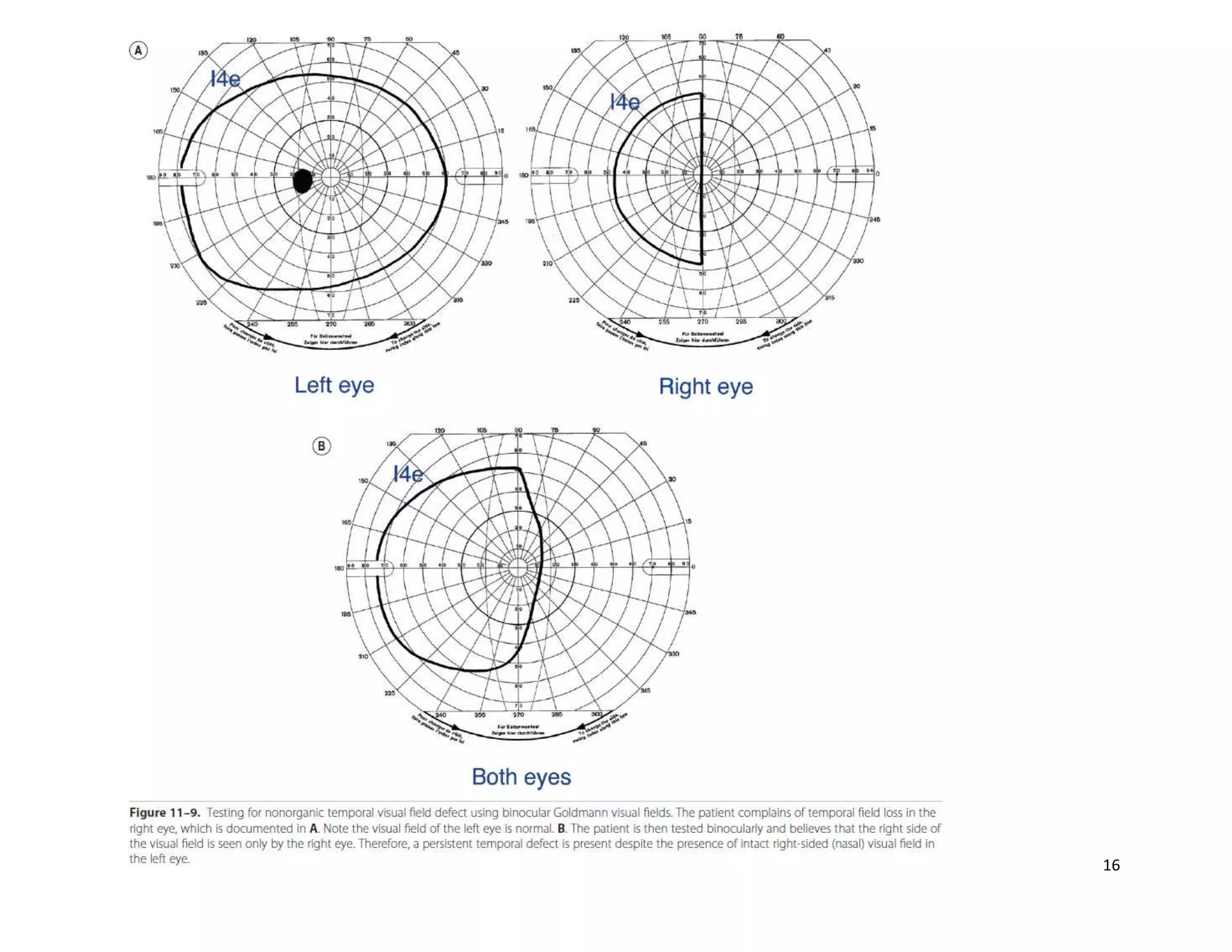 Functional vision loss table 2 | DOCX