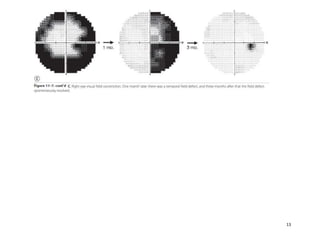 Functional vision loss table 2 | DOCX