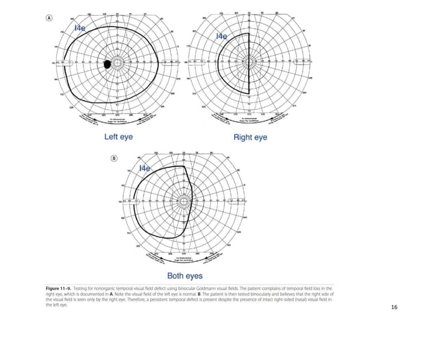 Functional vision loss table 2 | DOCX