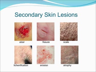 Erosion Skin Vs Ulcer