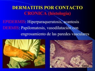 Dermatitis de contacto | PPS