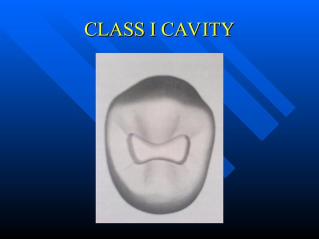Fundamentals-of-cavity-preparation endodontics | PPT