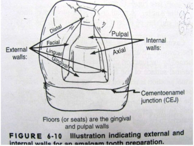 Fundamentals in tooth preparation