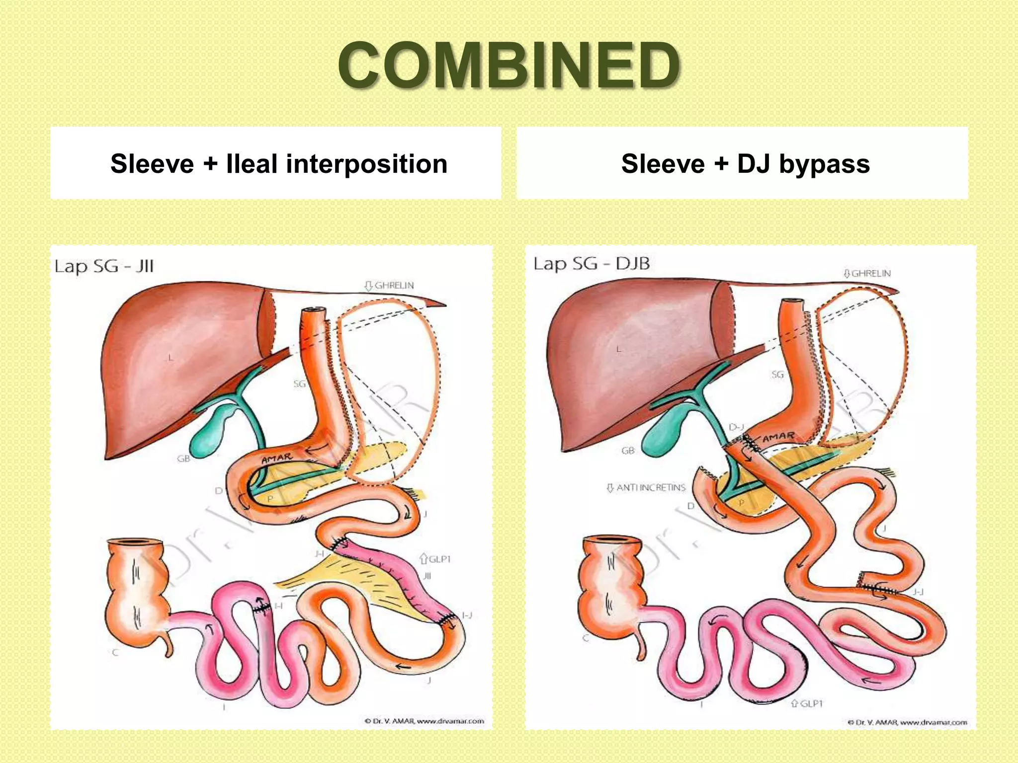 Fundamentals of bariatric and metabolic surgery | PPTX