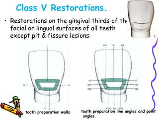 Fundamentals of tooth preparation - operative dentistry | PPT
