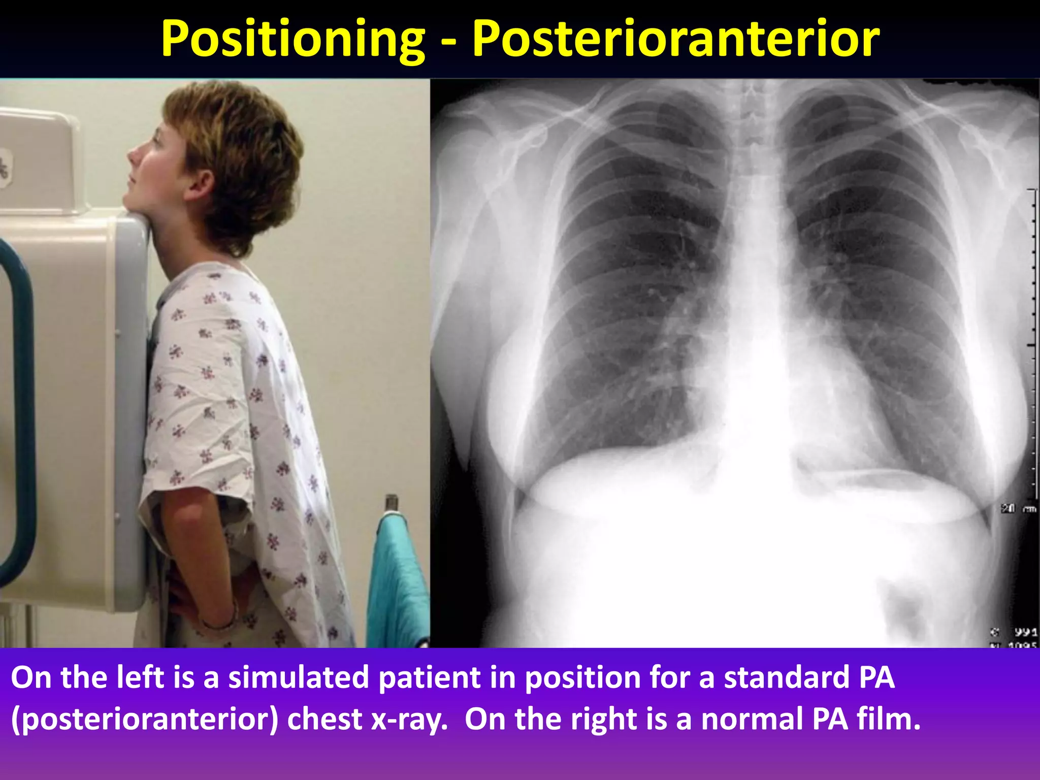 Fundamentals of chest radiology | PDF