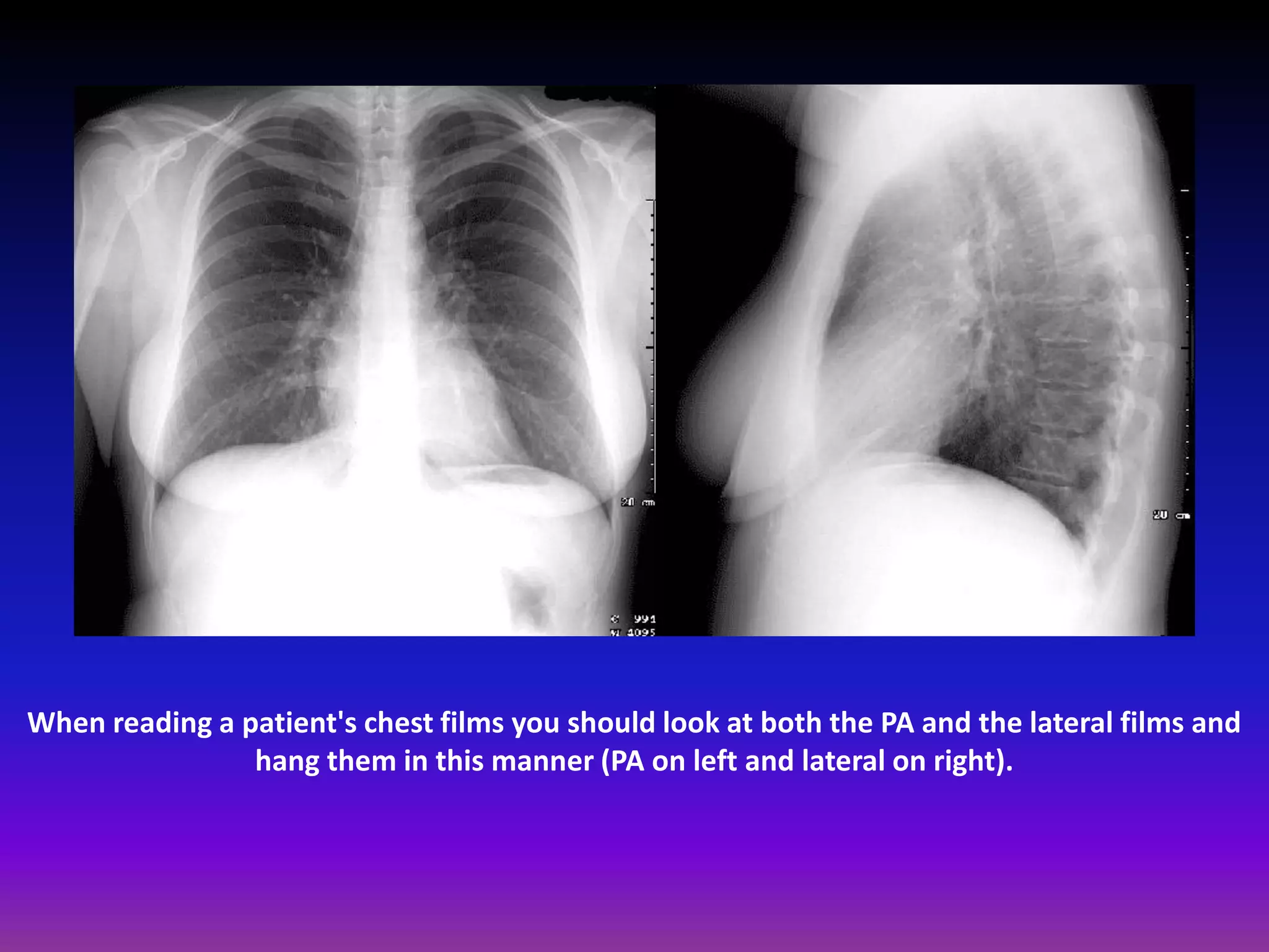 Fundamentals of chest radiology | PDF
