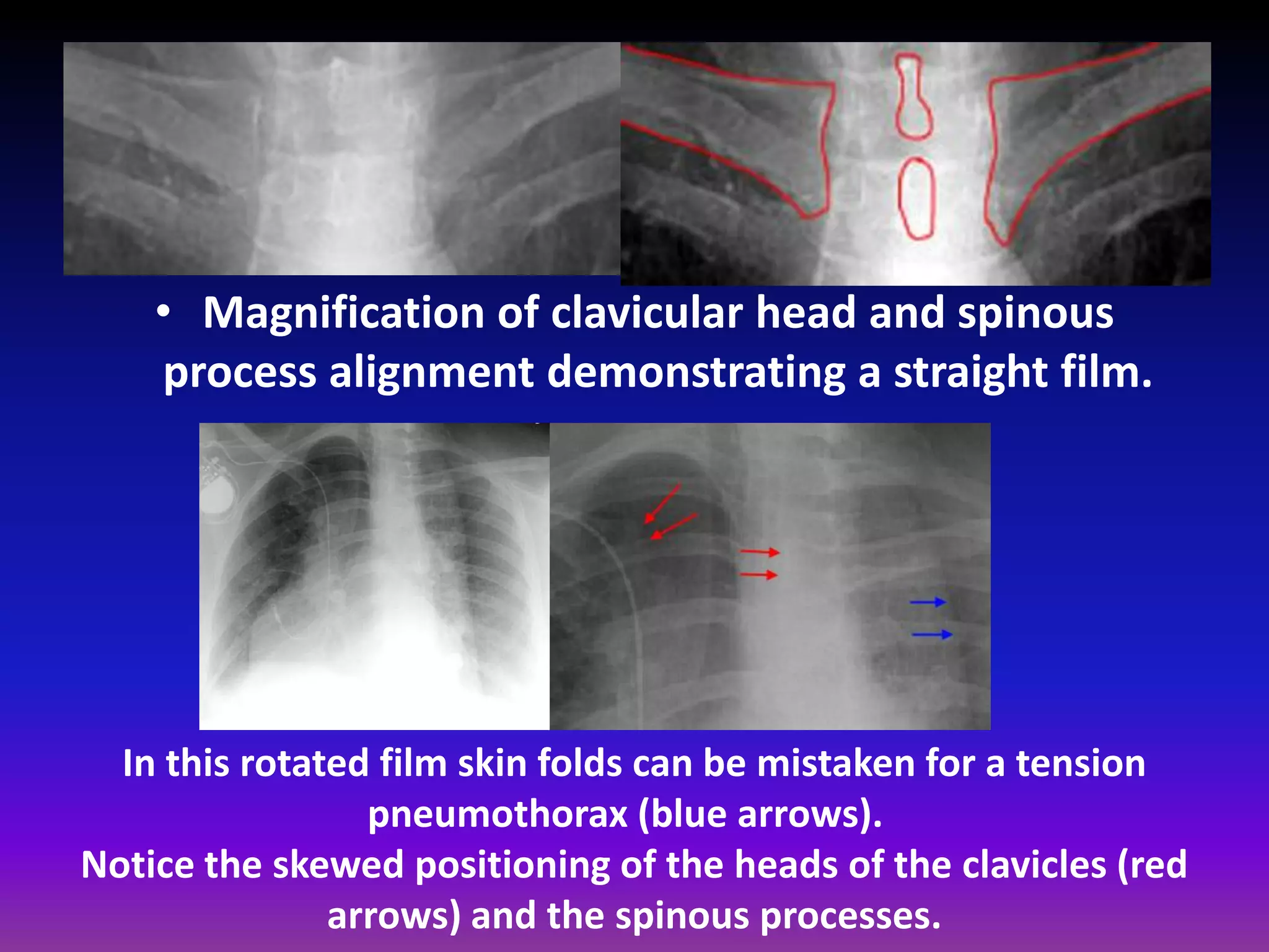 Fundamentals of chest radiology | PDF