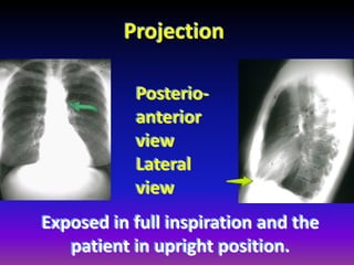 Fundamentals of chest radiology | PDF