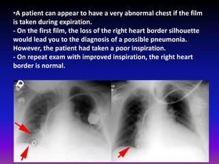 Fundamentals of chest radiology | PDF
