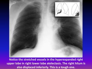 Fundamentals of chest radiology | PDF
