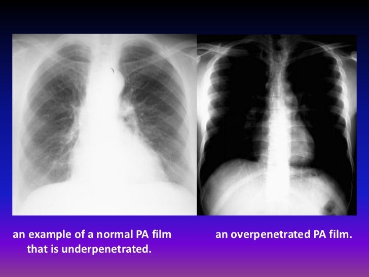 Fundamentals of chest radiology