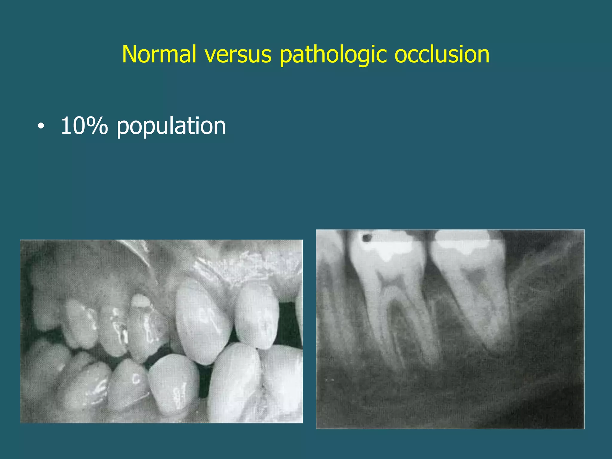 fundamentals of occlusion.pptx | Dental Health | Diseases and Conditions