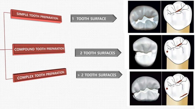 Fundamentals of Cavity preparation | PPTX | Dental Health | Diseases ...