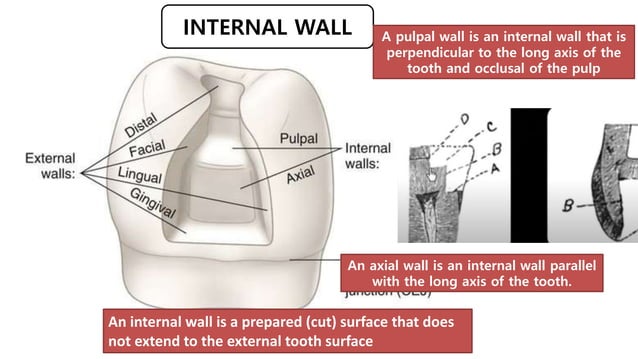 Fundamentals of Cavity preparation | PPTX | Dental Health | Diseases ...