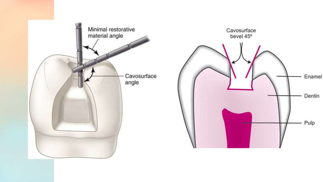 Fundamentals of Cavity preparation | PPTX | Dental Health | Diseases ...