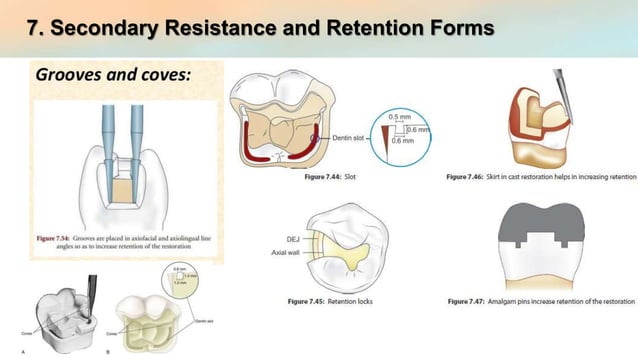 Fundamentals of Cavity preparation
