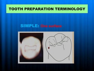 Fundamentals of tooth preparation 2013 | PPT