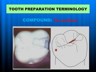 Fundamentals of tooth preparation 2013 | PPT