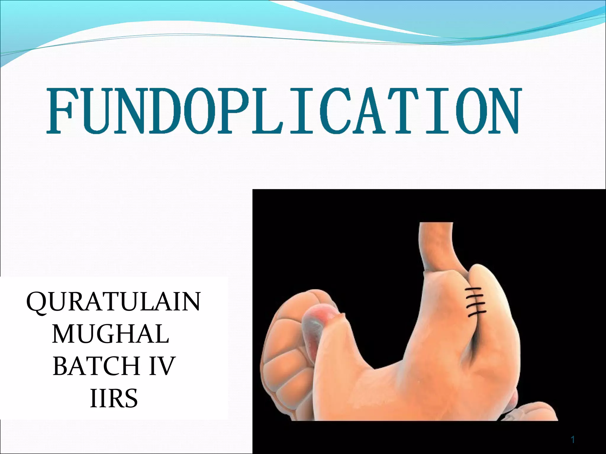 Fundoplication and heller's myotomy | PPT