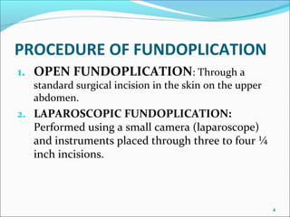 Fundoplication and heller's myotomy | PPT