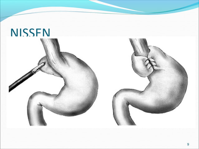 Fundoplication and heller's myotomy | PPT