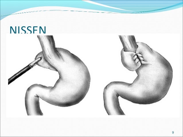 Fundoplication and heller's myotomy