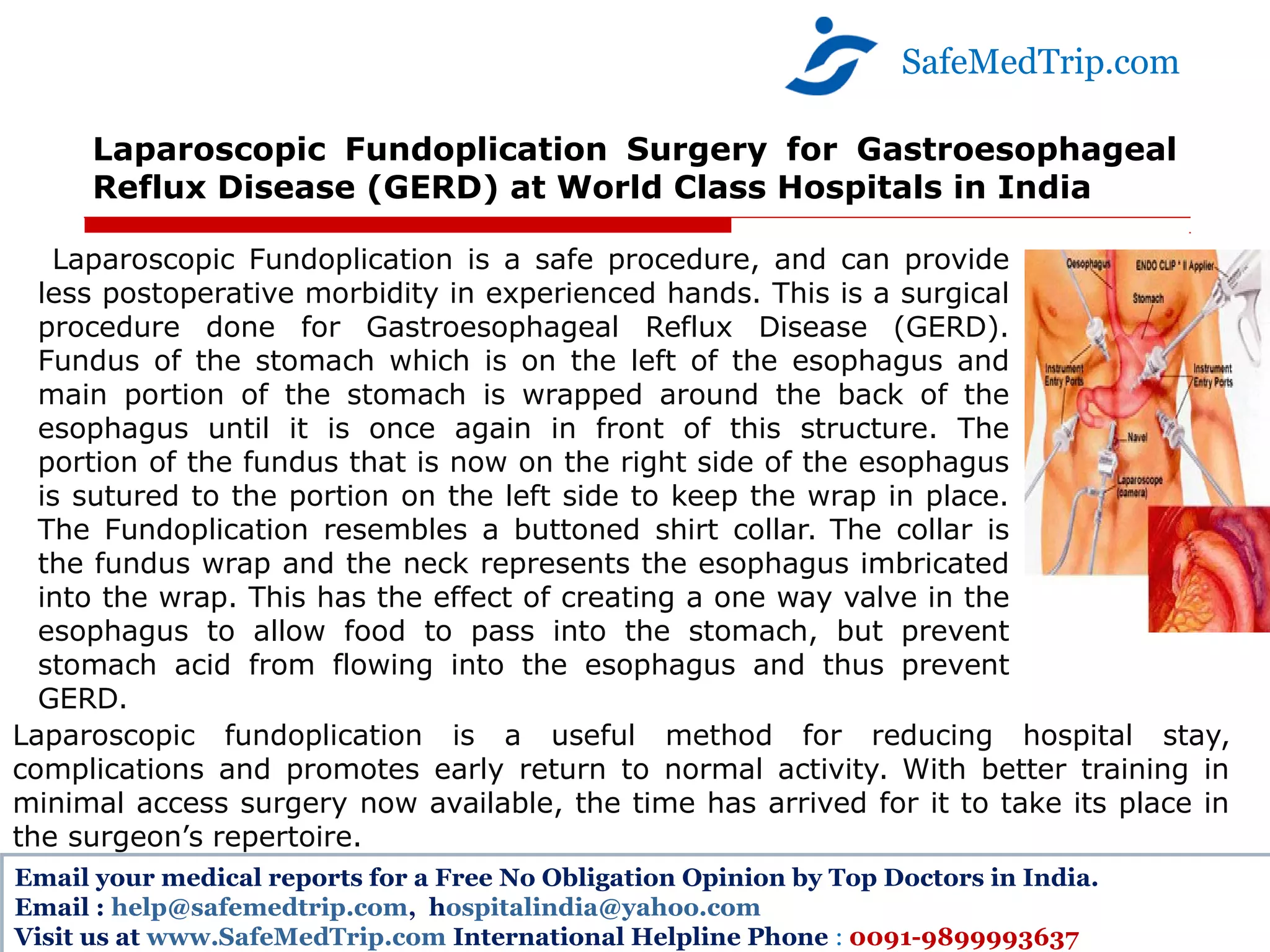 Highly Advanced Laparoscopic Fundoplication Surgery for ...