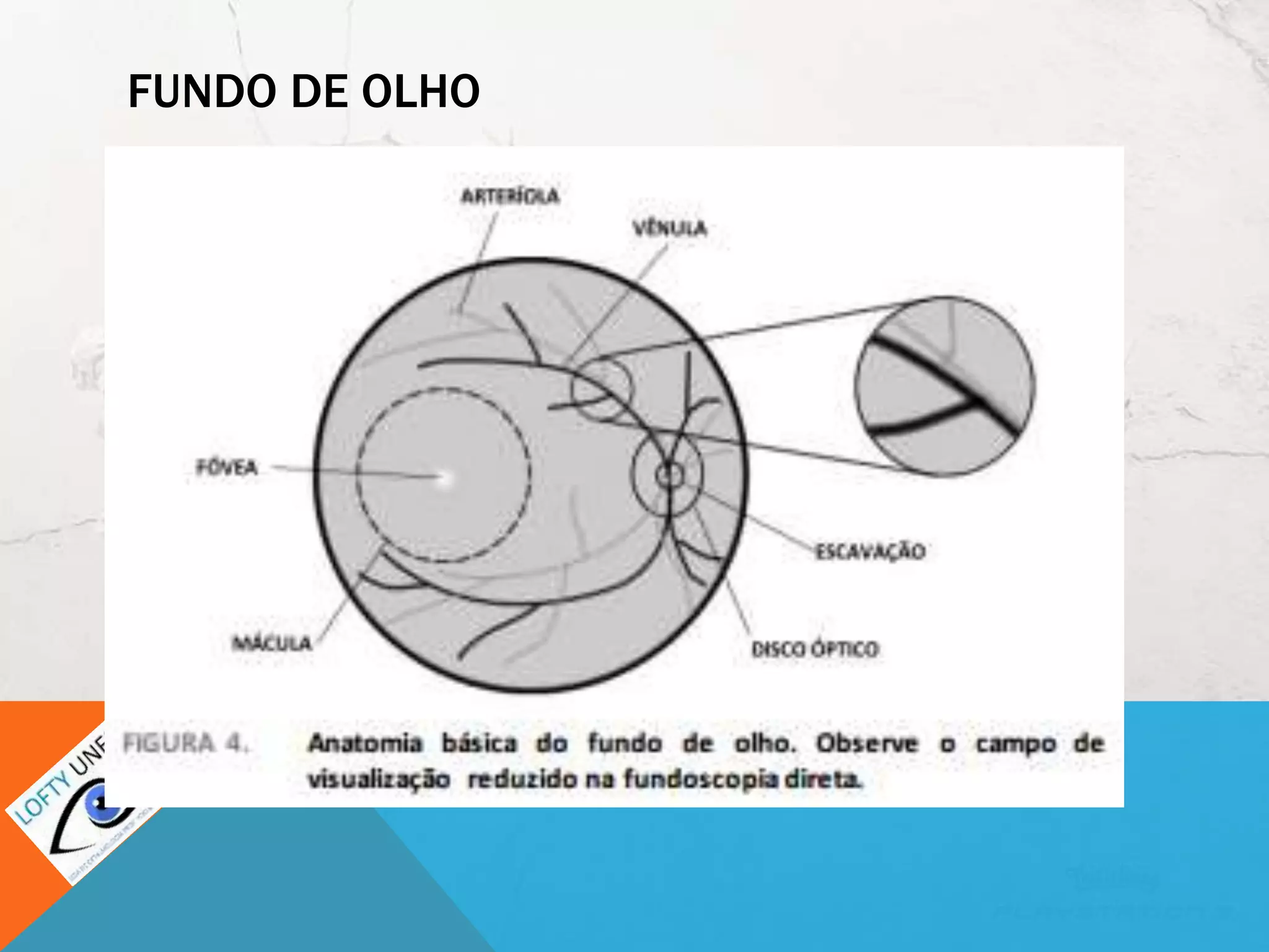 Fundoscopia direta | PPTX | Eye and Vision Conditions | Diseases and ...