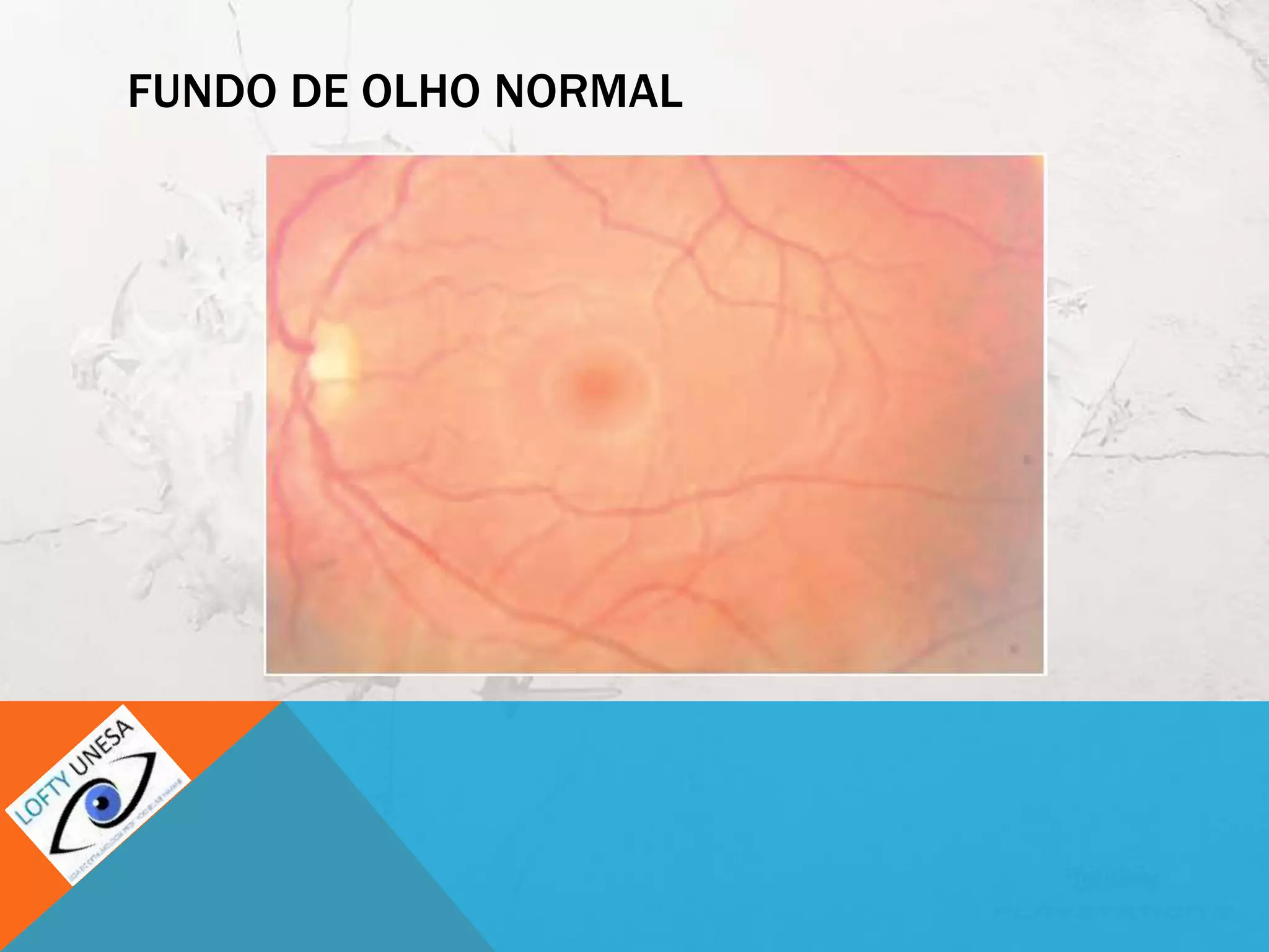 Fundoscopia direta | PPTX | Eye and Vision Conditions | Diseases and ...