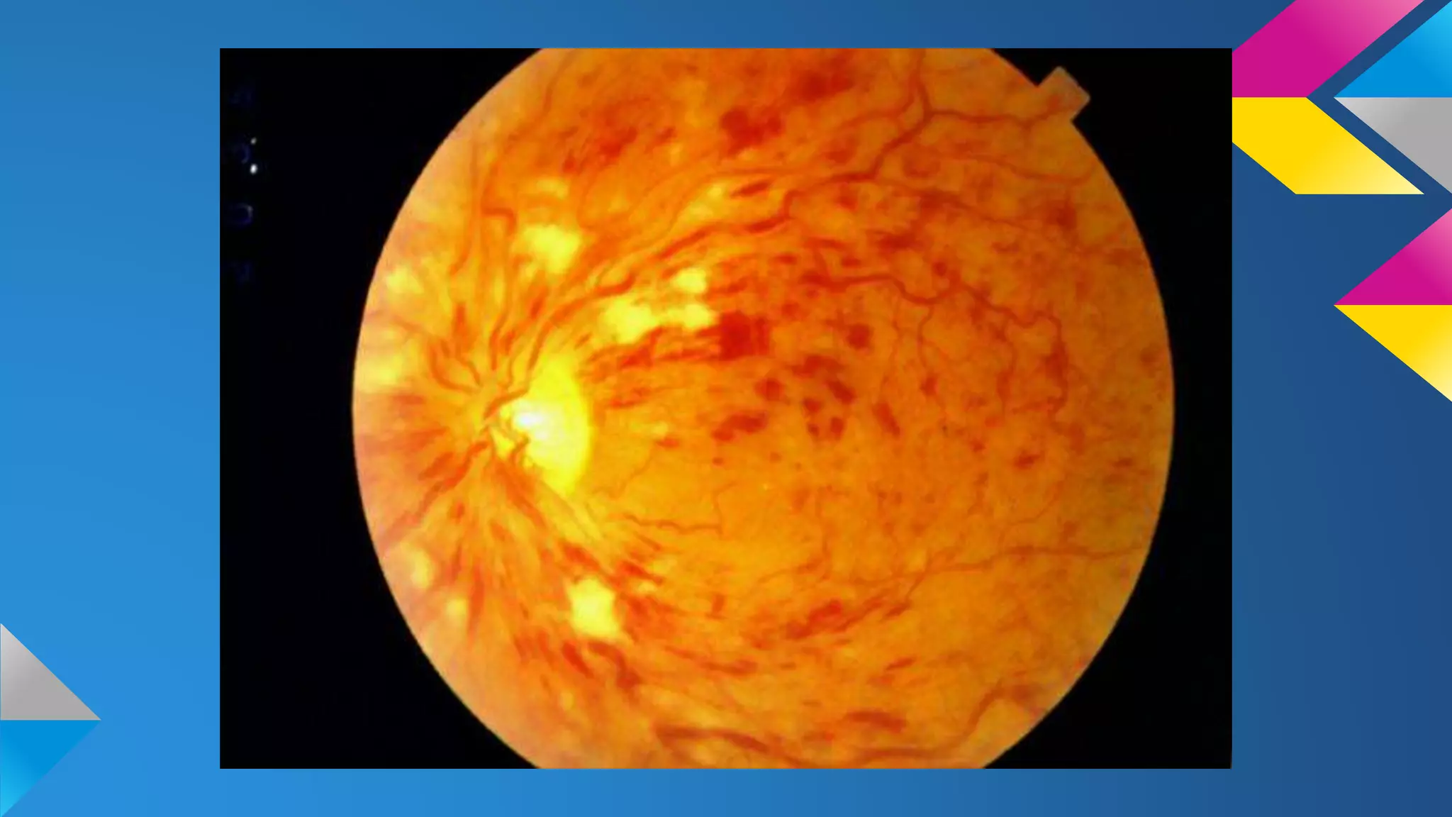 Fundoscopy Pictures | PPTX