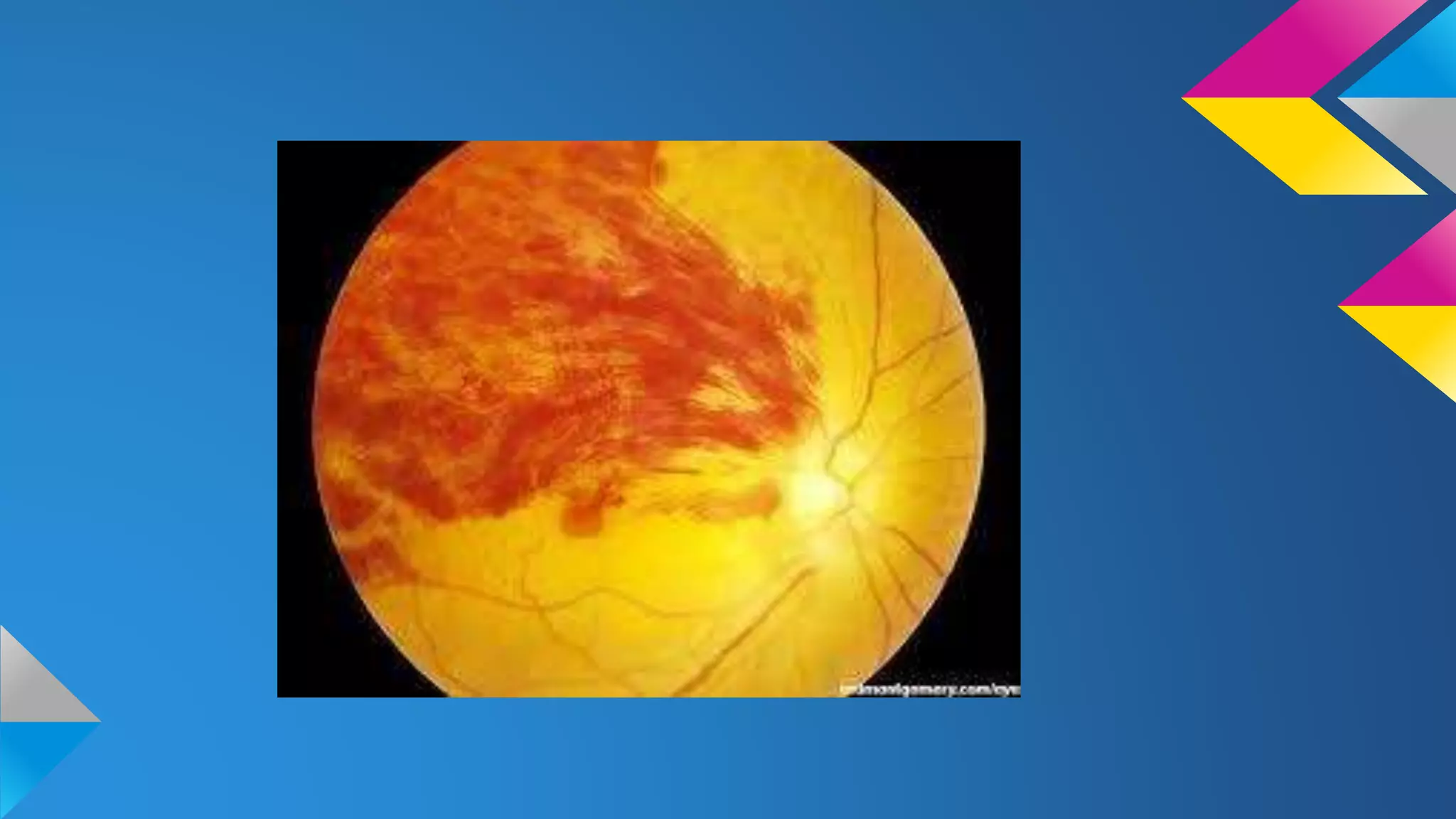 Fundoscopy Pictures | PPTX