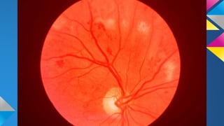 Fundoscopy Pictures | PPTX